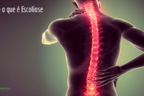 Entenda o que é Escoliose | Cirurgião de Coluna Itaim Bibi