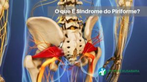 O que É Síndrome do Piriforme? | Cirurgião de Coluna Itaim Bibi