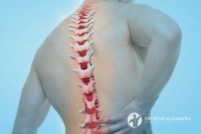 Osteófitos na Coluna: o que Significa? | Cirurgião de Coluna Itaim Bibi