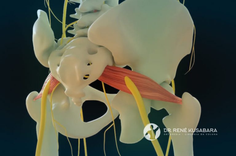 O que É Síndrome do Piriforme? | Cirurgião de Coluna Itaim Bibi