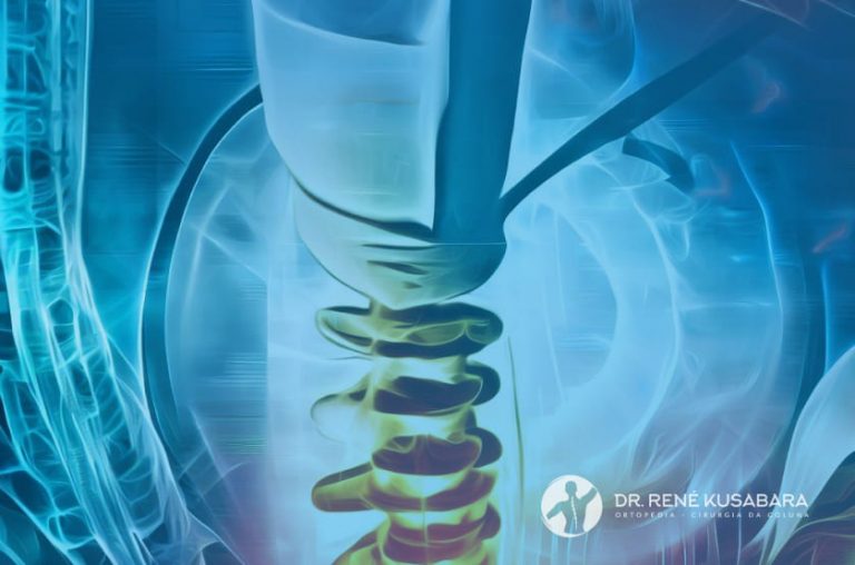 Cirurgia Endoscópica para Estenose Espinhal | Dr René Kusabara